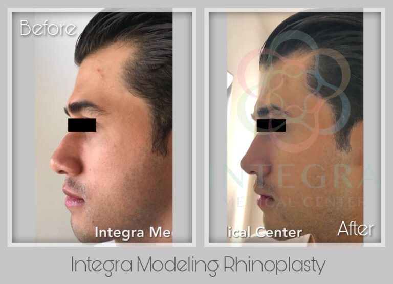 Cosmetic Surgery in Mexico – Integra Medical Center