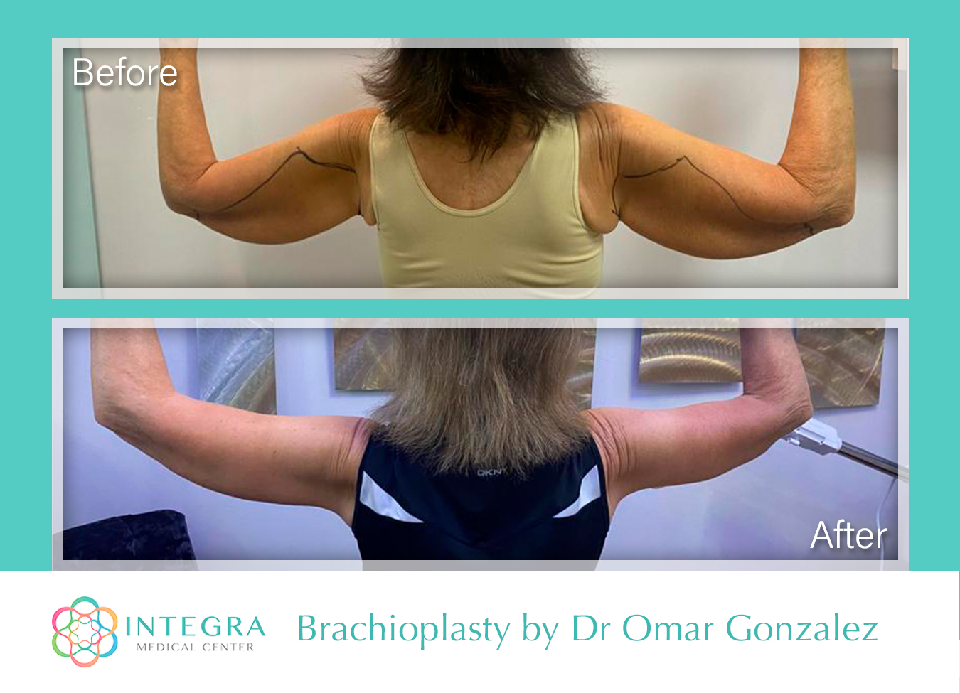 Cosmetic Surgery in Mexico – Integra Medical Center